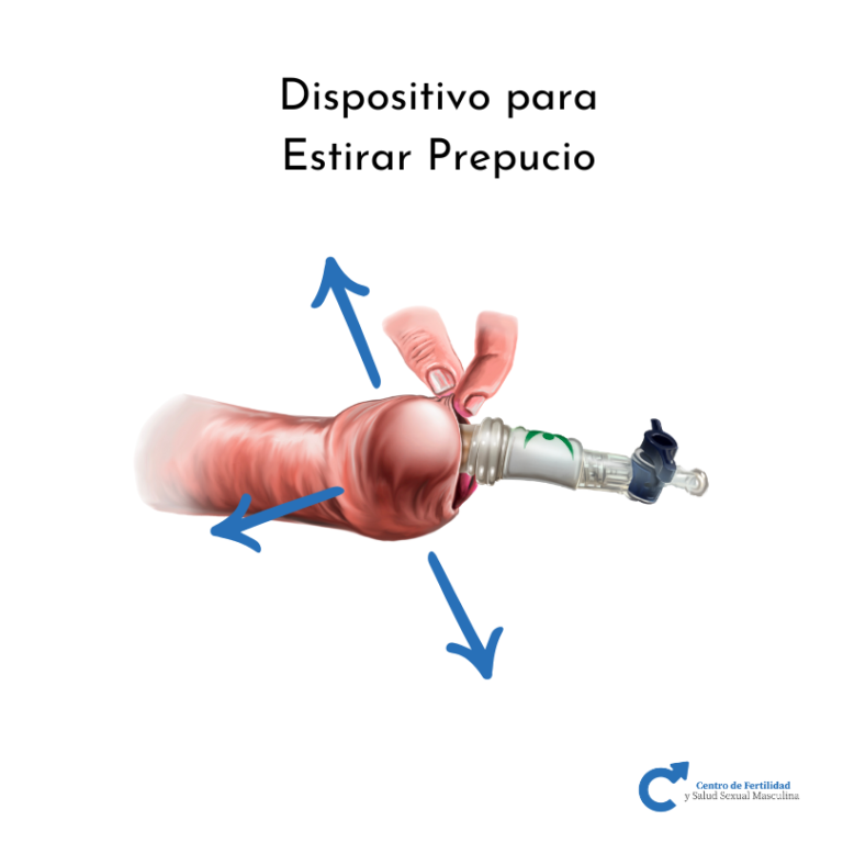 Ejercicios para Bajar el Prepucio: ¿Funcionan en Niños y Adultos?